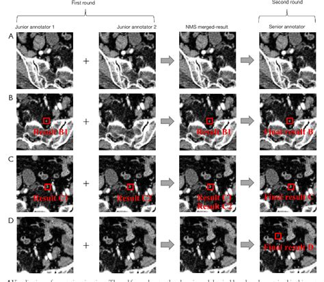 Figure 1 From An Attention Based Neural Network Model For Automatic Partition Of Abdominal Lymph
