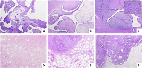 Morphological Features Of A Borderline Phyllodes Tumor On Surgical