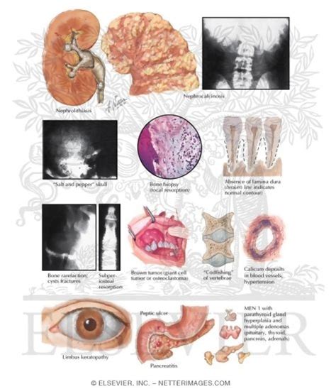 Pathology And Clinical Manifestations Of Primary Hyperparathyroidism