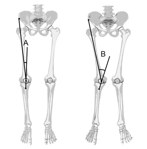 Q Angle Of Normal Knee Joint Is Close To 0° A Whereas In Valgus Knee Download Scientific