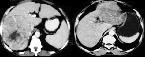 Ct Scan Showing Large Exophytic Hepatocellular Carcinoma In Cirrhotic Download Scientific