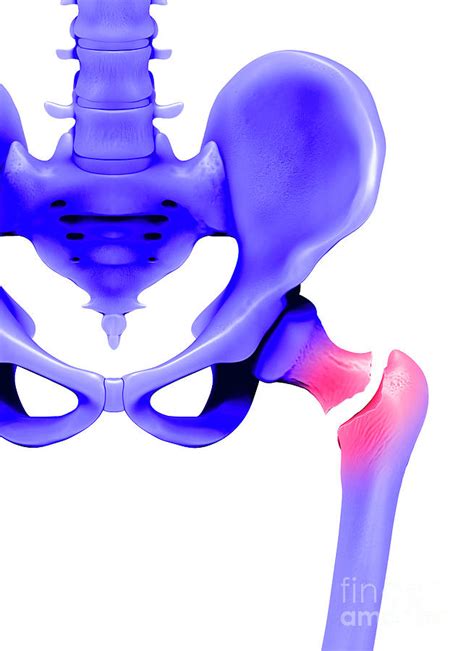 Femure Fracture 1 Photograph By Tim Vernon Science Photo Library