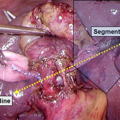 Critical View Of Safety Cvs Is Secured Using The Segment Iv Approach