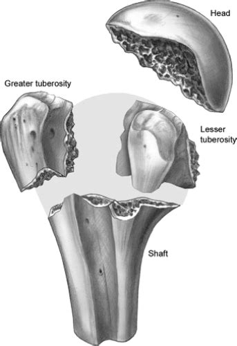 Proximal Humeral Fractures Open Reduction Internal Fixation Musculoskeletal Key