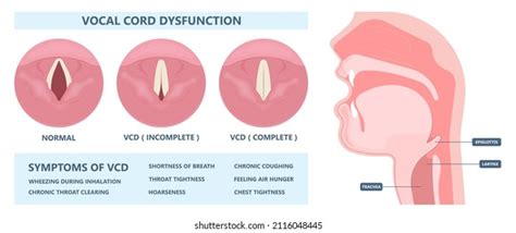 Vocal Cord Dysfunction
