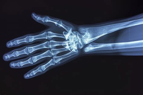 Premium Photo This Xray Image Depicts A Hand With A Skeleton Hand