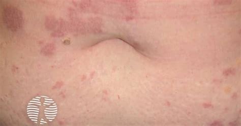 Granuloma Annulare Image