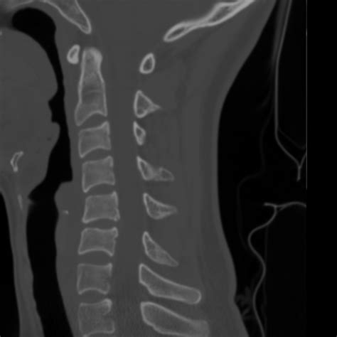 Cervical Spine Hyperflexion Injuries By Alexander Baxter