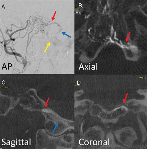 Figure 4 From The Anterior Condylar Arteriovenous Fistula From The Viewpoint Of The Osseous