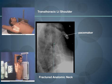 Ppt Shoulder Girdle Powerpoint Presentation Free Download Id 5415018