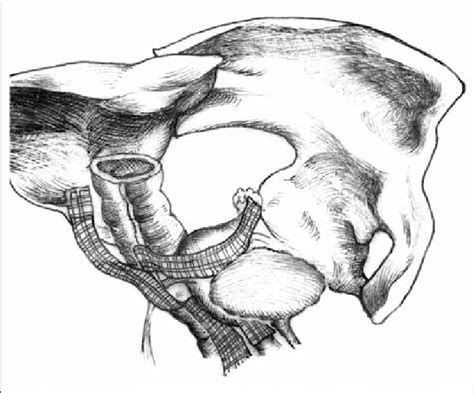 The Abridged General View Of Laparoscopic Sacral Colpopexy For Uterine
