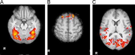 Activation In Response To Affective Faces Shown With Covert Or Rapid Download Scientific