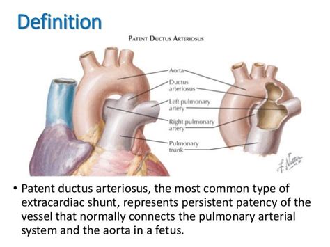 Patent Ductus Arteriosus Pda