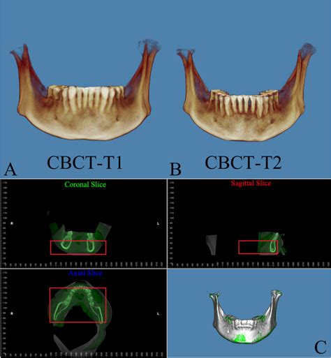 A Pretreatment Cbct Cbct T1 B Posttreatment Cbct Cbct T2 C Download Scientific Diagram