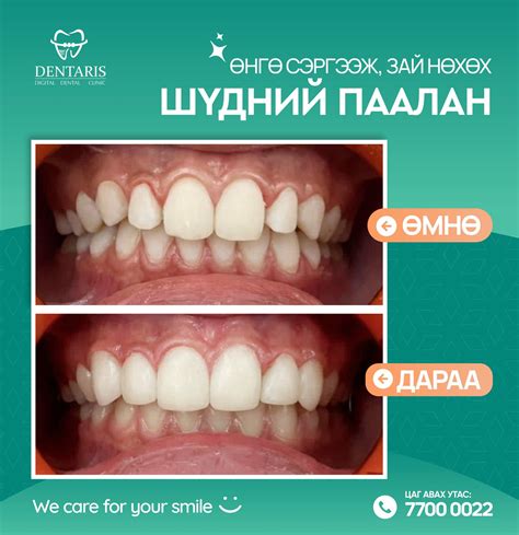 Dentaris Шаазан паалан эмчилгээ 💫Үр дүн шууд харагдана 💫Гоо сайхан бүрэн сэргэнэ Тухайн