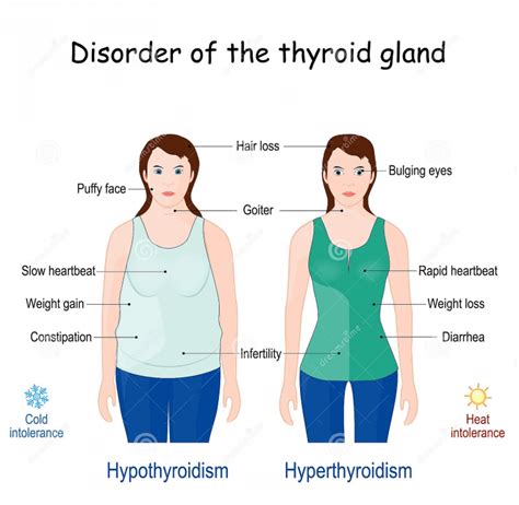 Overactive Thyroid Symptoms Causes Diagnosis And More Ltg