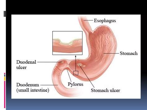 Pathology Of Peptic Ulcer Pptx