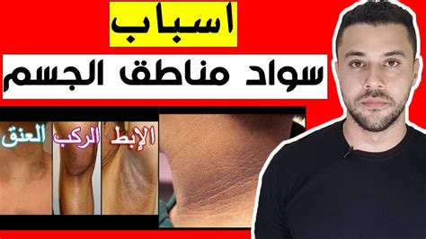 أسباب ظهور البقع السوداء فى الجسم سبب سواد الرقبة والإبط والتخلص منهم
