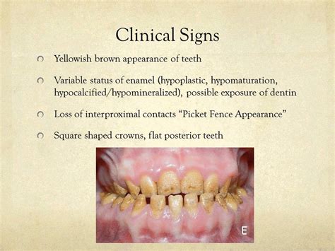 Amelogenese Imperfeita Hipocalcificada Amelogênese Imperfeita Relato