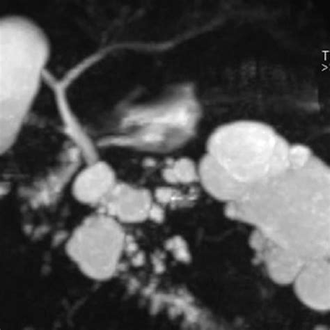 Magnetic Resonance Imaging With Cholangiopancreatography Mrcp Download Scientific Diagram