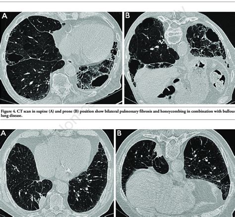 Ct Scan In Supine A And Prone B Position Demonstrate A Right Lower Download Scientific