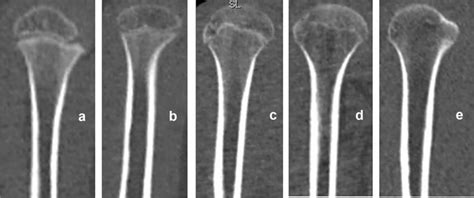 The Process Of Proximal Humeral Epiphyseal Fusion Based On Mckern And Download Scientific