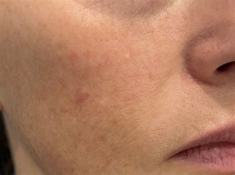 Morpheus8 REDEEM Sexual Wellness And Aesthetics Center