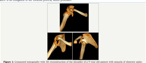 Coracoid Deformity In Obstetric Brachial Plexus Palsy Semantic Scholar