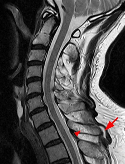 Cervical Interspinous Bursitis Radsource