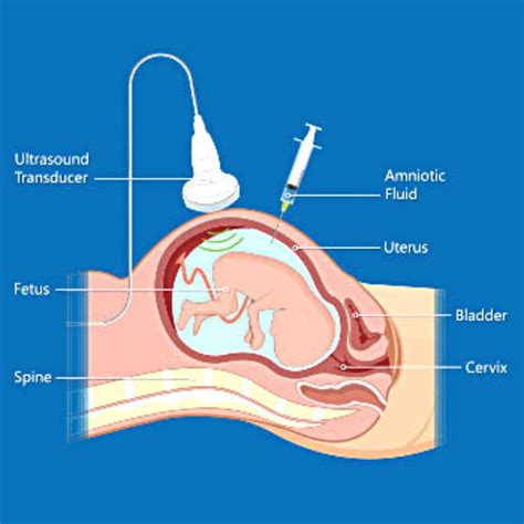 Who Performs Amniocentesis Procedure