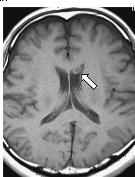 Figure 1 From Ring Shaped Lateral Ventricular Nodules Detected With