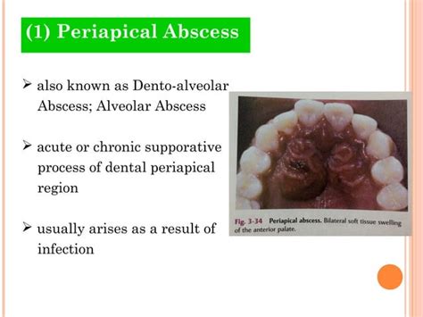 Abnormalities Of The Pulp Ppt Dental Health Diseases And Conditions