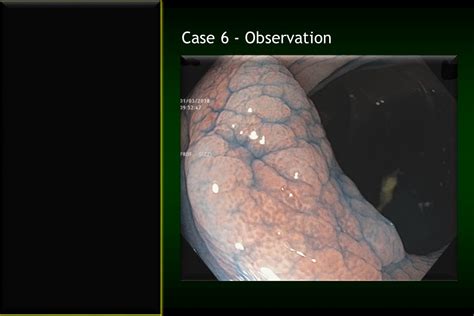 Pit Pattern Classification Colon Explorer