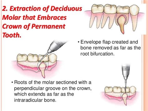 Principles And Steps Of Surgical Tooth Extraction