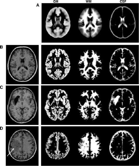 Figure 1 From Lesion Identification Using Unified Segmentation