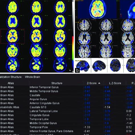 A 82 Year Old Male With Semantic Ppa Fusion Fluorodeoxyglucose Download Scientific Diagram