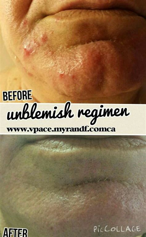 My Husband Had What Doctors Called Barbers Rash This Is 2 Weeks Of Using Unblemish Regimen