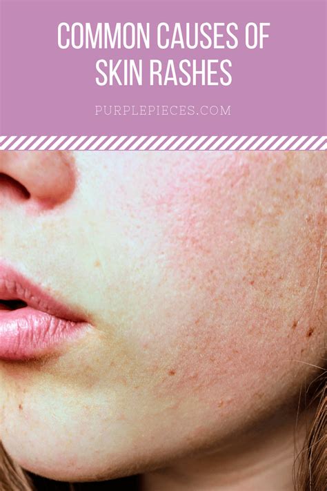 Common Causes Of Skin Rashes