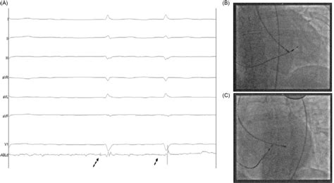 Intracardiac Electrogram Recordings A From The Download Scientific Diagram