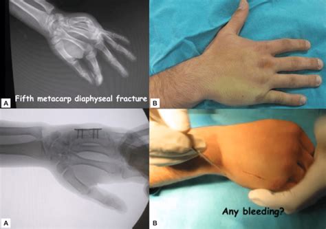 A Fifth Metacarp Diaphyseal Fracture Open Osteosynthesis With Plate Download Scientific