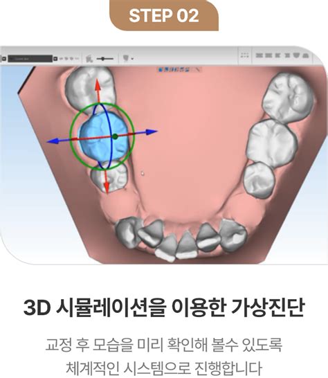 치아교정아름다운턱치과