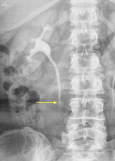Intravenous Urography Pacs
