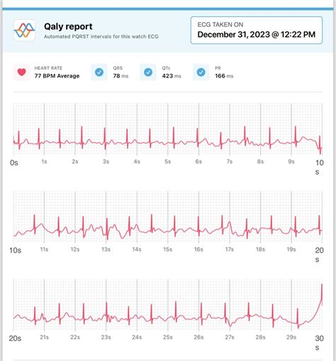 Can Someone Help Me Understand Those T Waves R ReadMyECG