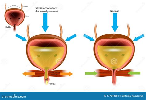 Urinary Incontinence Infographic Cartoon Vector