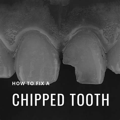 How To Fix A Chipped Tooth West Palm Beach Dentist