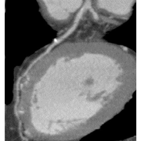 CT Volume Rendering And Curved A B Of The Anterior Descending Download Scientific