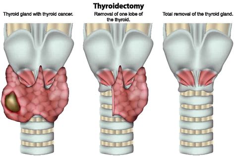 Thyroid Gland And Thyroidectomy Functions And Cpt Codes