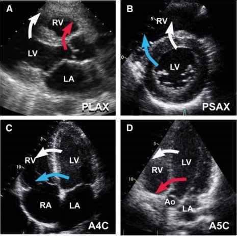 Pin By Phuong Hoai On Cardiac Ultrasound Diagnostic Medical