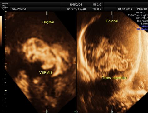 Choroid Plexus Cyst Looking Through A Transducer