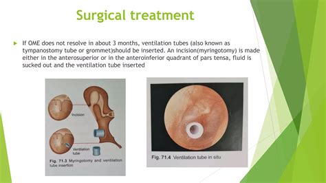 Otitis Media With Effusionpptx